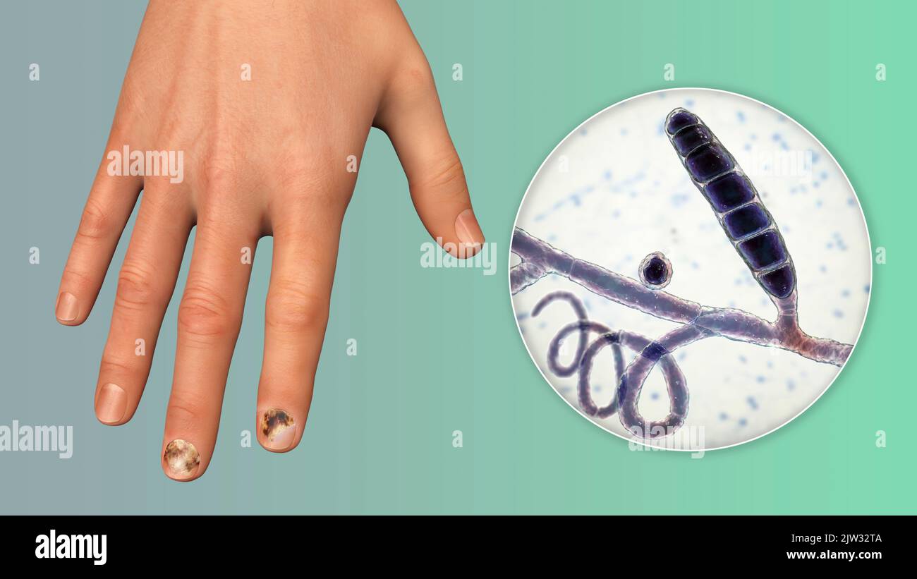Illustrazione di un'infezione fungina delle unghie che mostra una mano ...