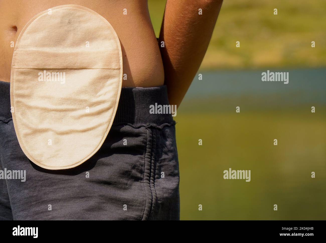 Colostomy stoma immagini e fotografie stock ad alta risoluzione - Alamy