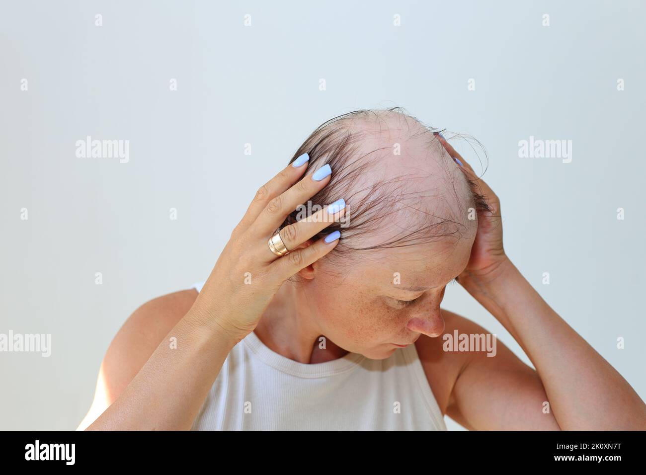 Perdita di capelli sotto forma di alopecia areata. Testa calva di una ...