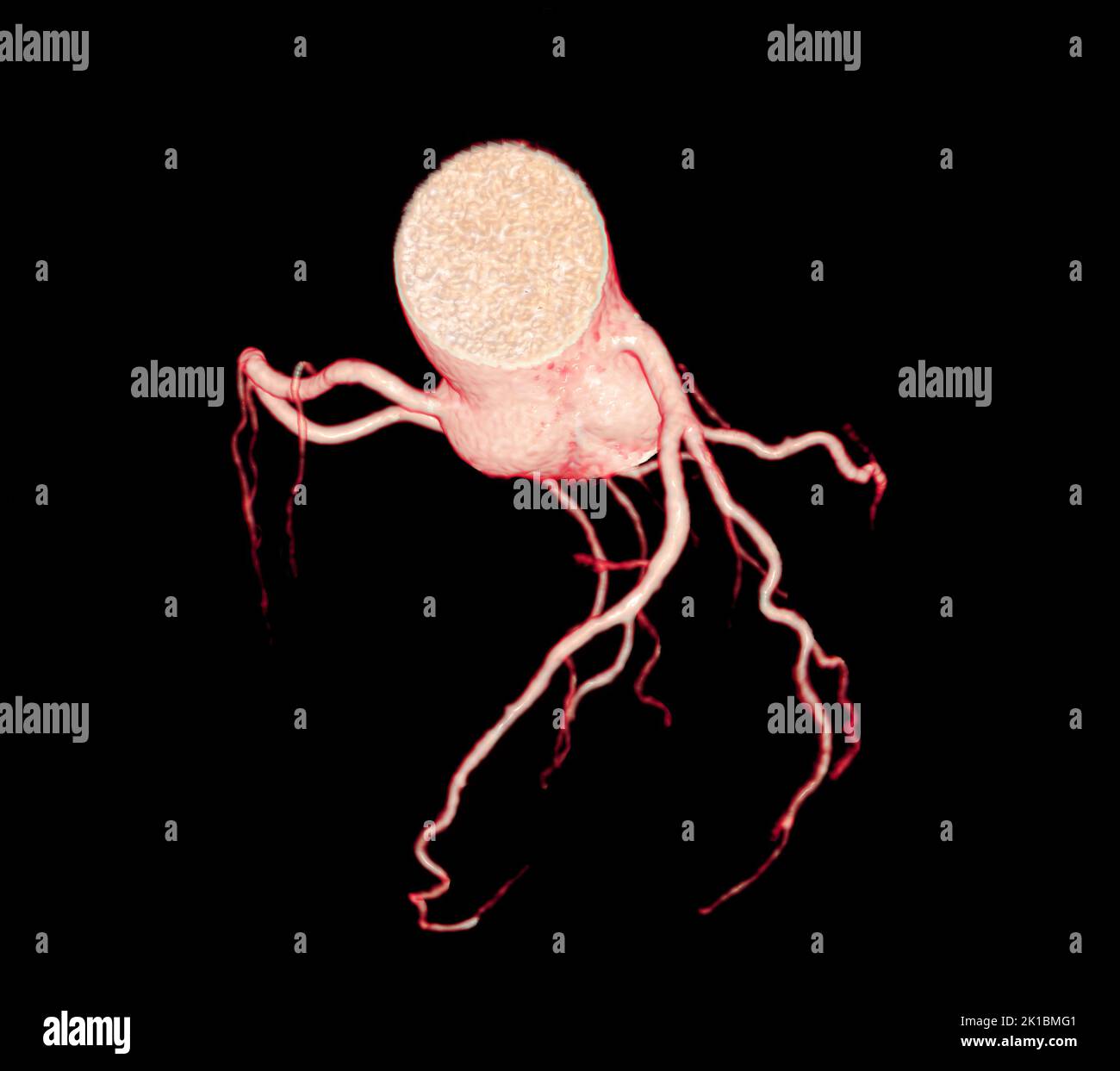 Angiografia cardiaca ct immagini e fotografie stock ad alta risoluzione ...