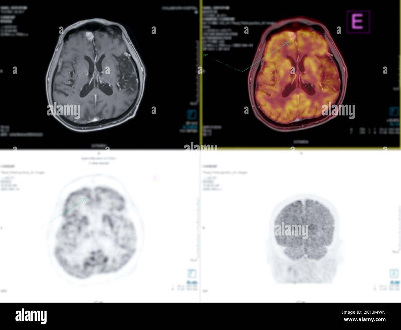 Pet ct scan immagini e fotografie stock ad alta risoluzione - Alamy