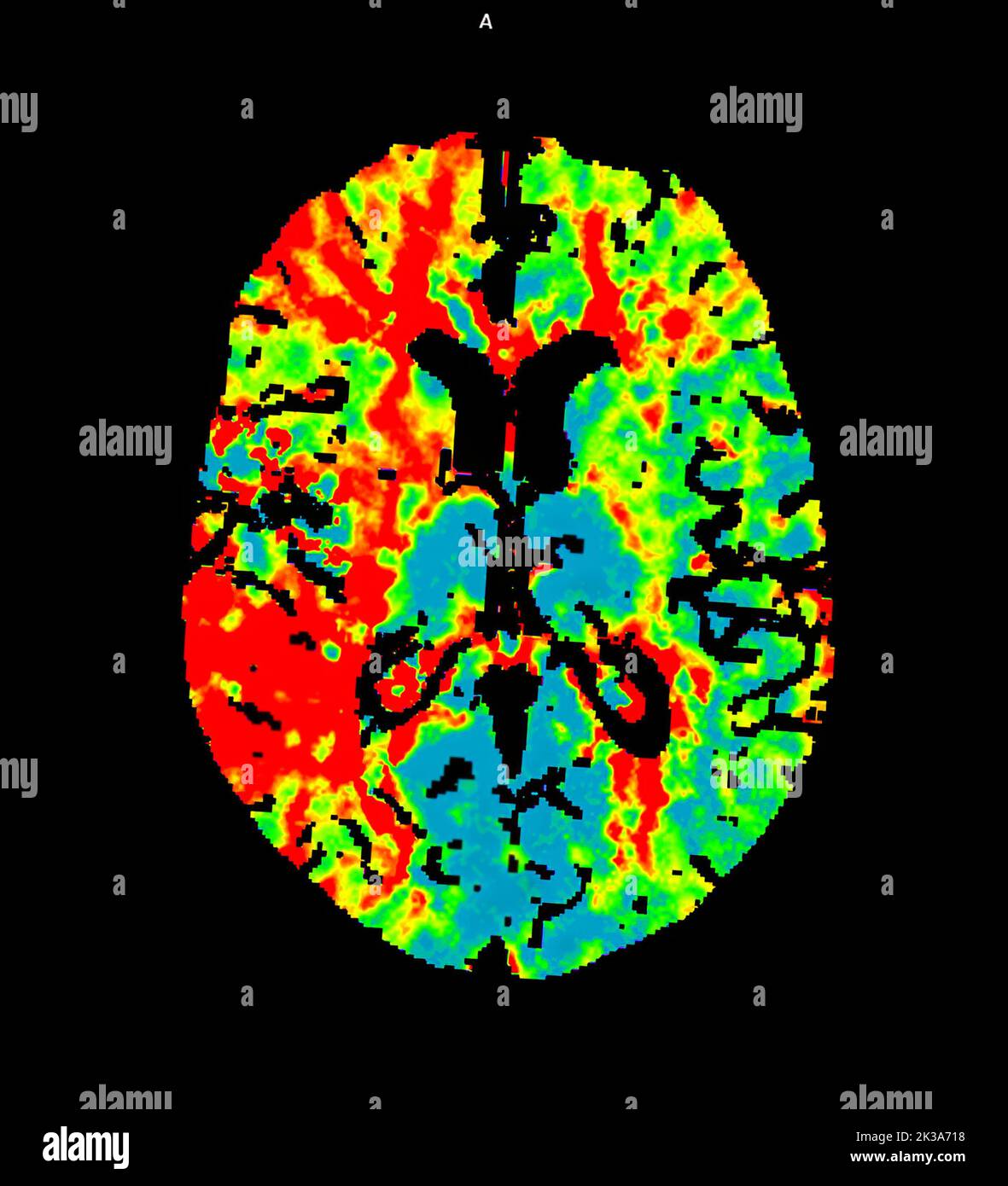 Vista assiale della perfusione TC del cervello con contrasto che mostra ...