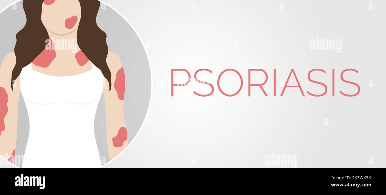 Dermatologo paziente psoriasi Immagini Vettoriali Stock - Alamy