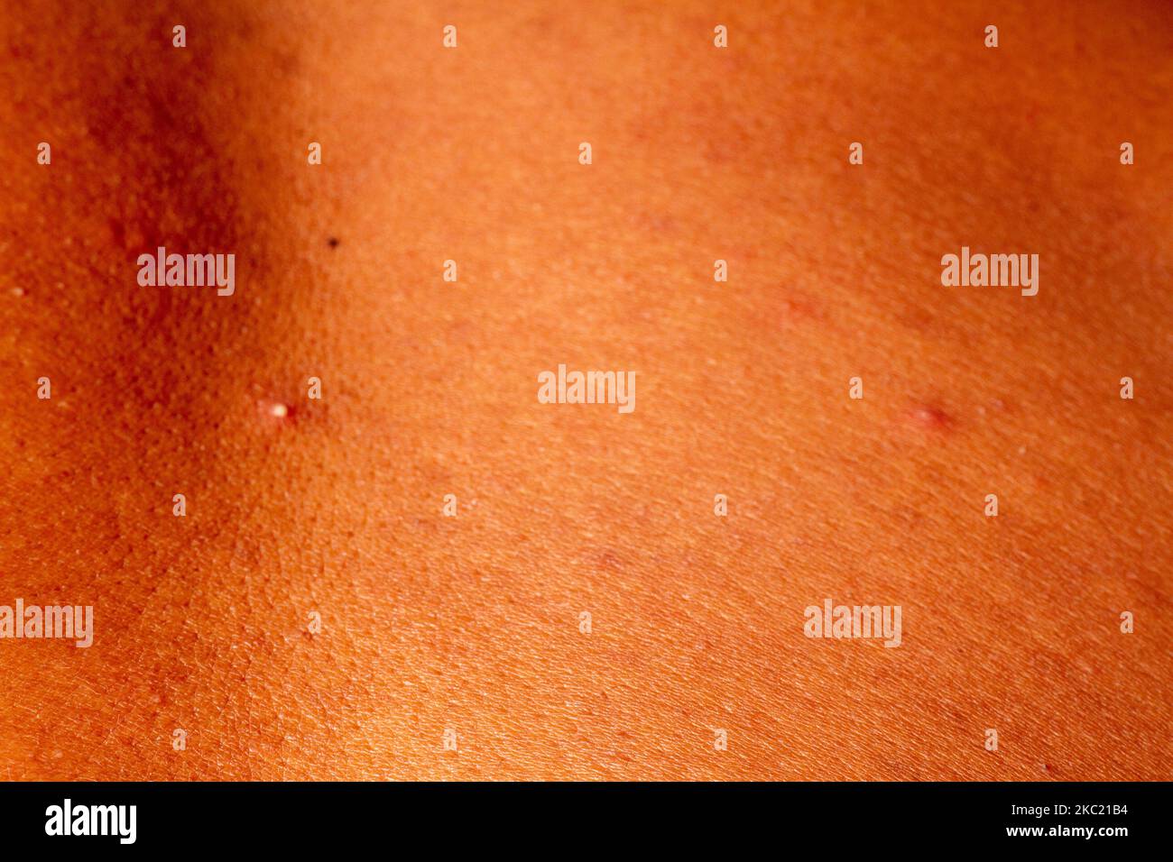 Papilloma della pelle immagini e fotografie stock ad alta risoluzione ...