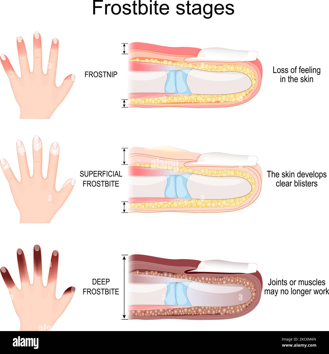 Frostbite stages of fingers. From Frostnip with Loss of feeling in the ...