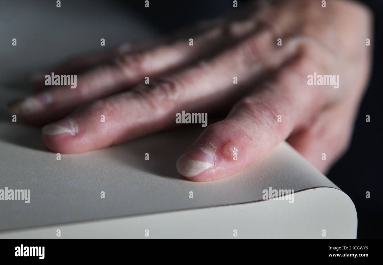 Ganglion cysts immagini e fotografie stock ad alta risoluzione - Alamy