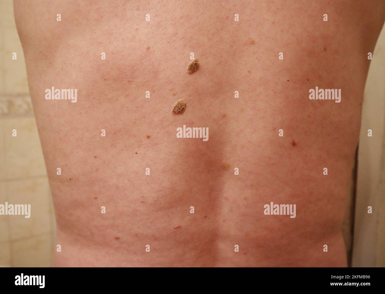 Melanoma on the face immagini e fotografie stock ad alta risoluzione ...