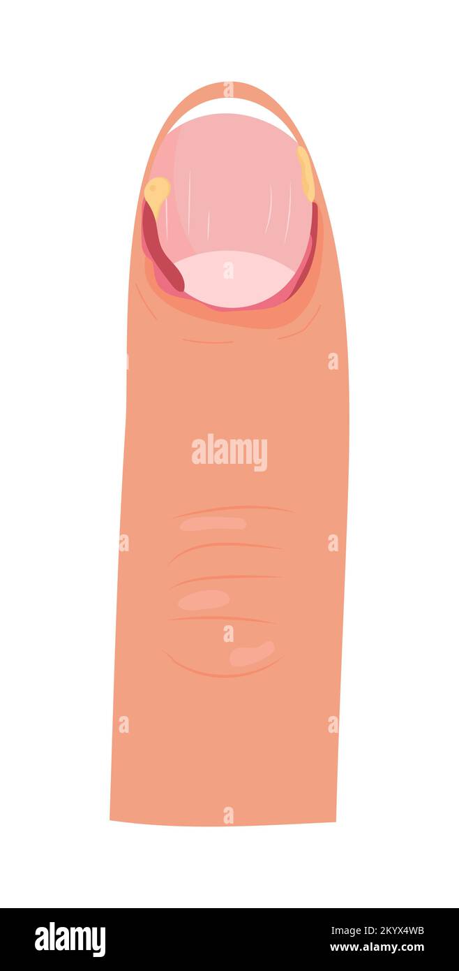 Trauma dell'unghia del piede immagini e fotografie stock ad alta ...