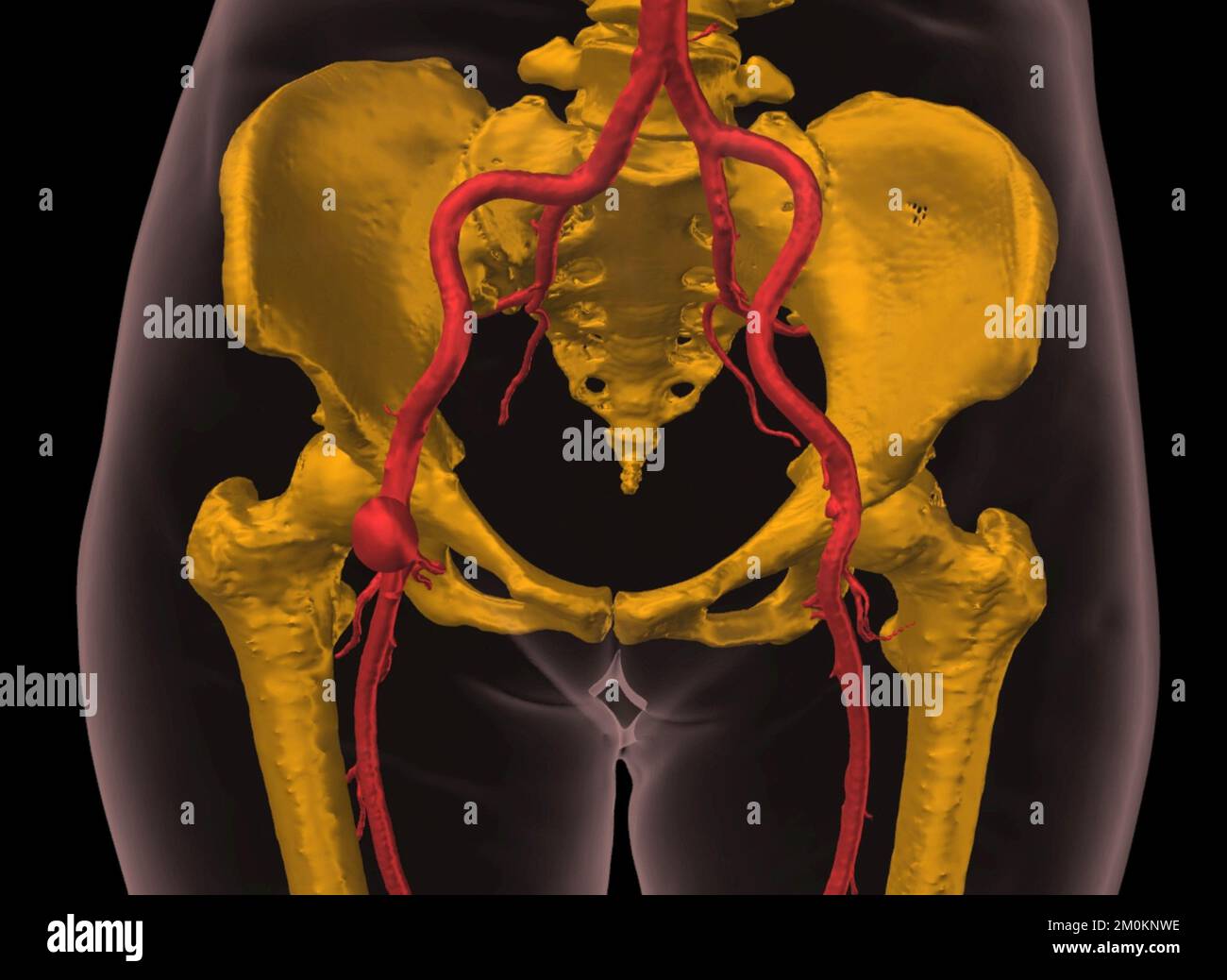 Pseudoaneurisma dell'arteria femorale, scansione TC 3D Foto stock - Alamy