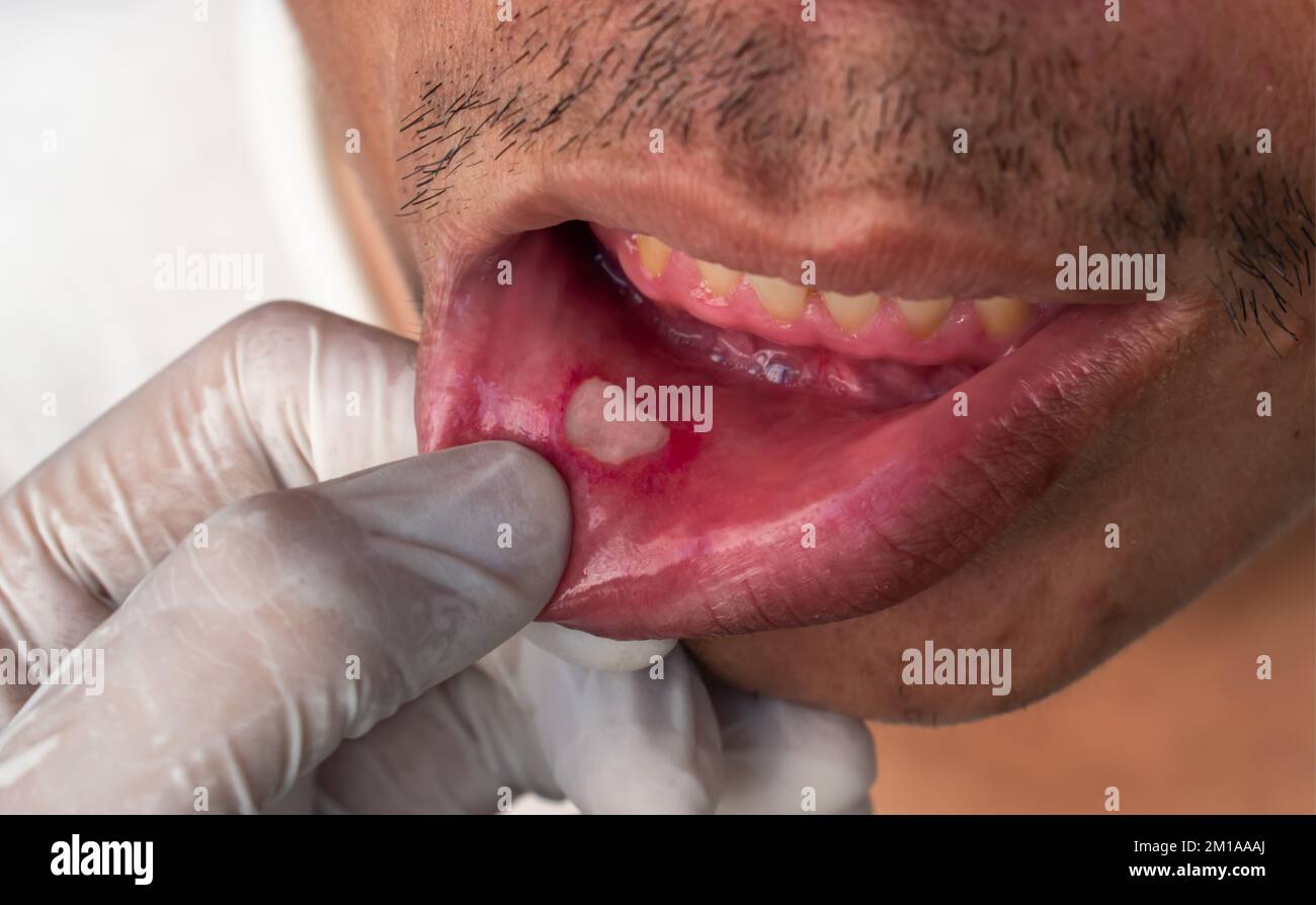 Ulcera da afta immagini e fotografie stock ad alta risoluzione - Alamy