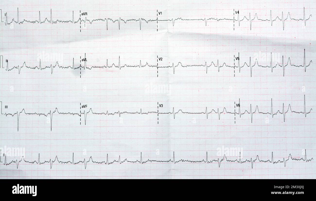 Carta per elettrocardiogramma ECG che mostra NSR ritmo sinusale normale ...