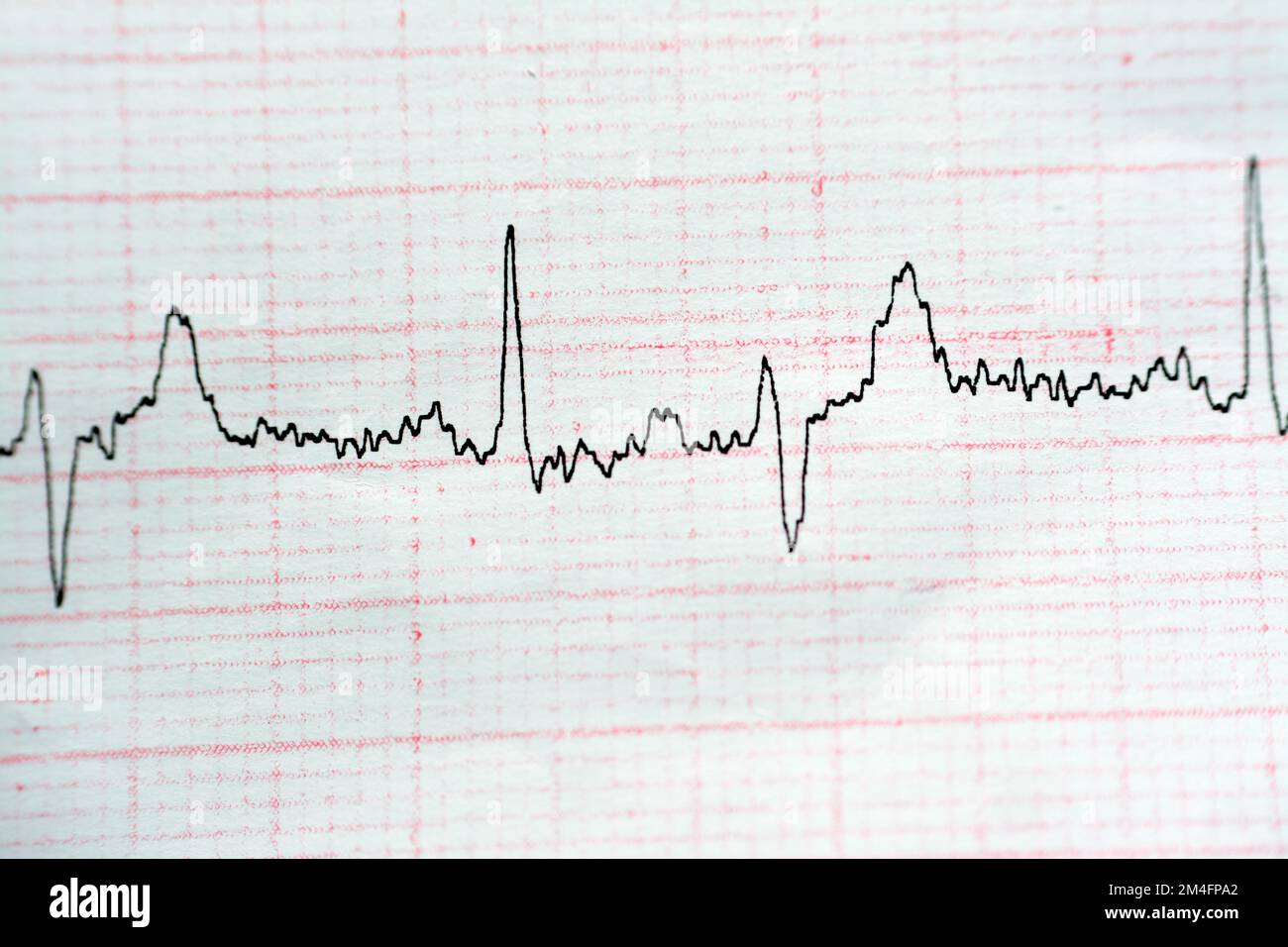 Carta per elettrocardiogramma ECG che mostra NSR ritmo sinusale normale ...