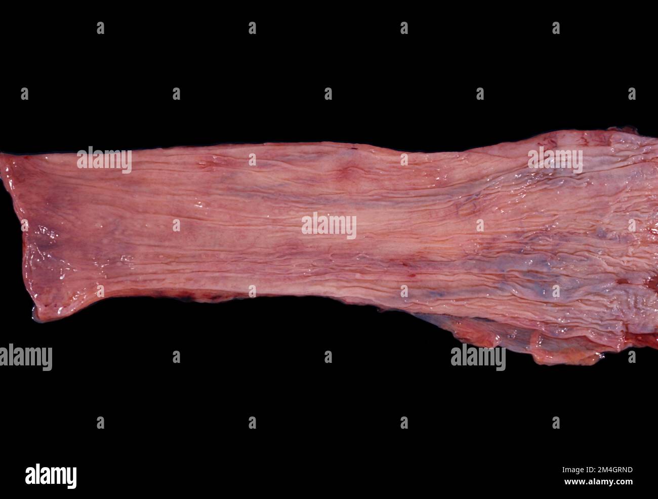 Esofago umano aperto con varici esofagee. Si tratta di vene submucosali ...