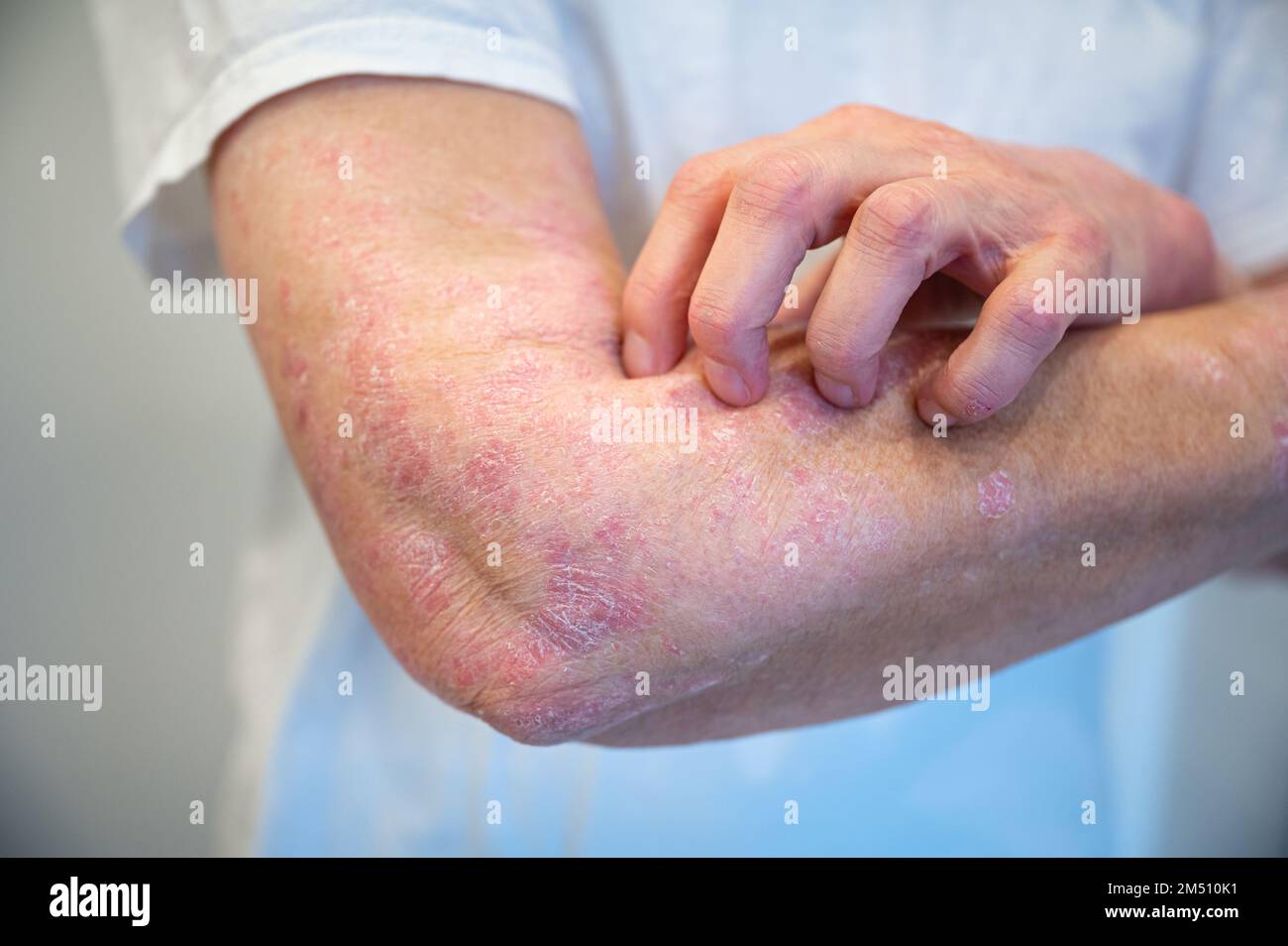 Psoriasi della malattia immagini e fotografie stock ad alta risoluzione ...
