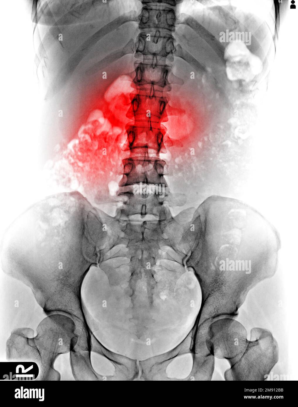 Radiografia dell'addome immagini e fotografie stock ad alta risoluzione ...