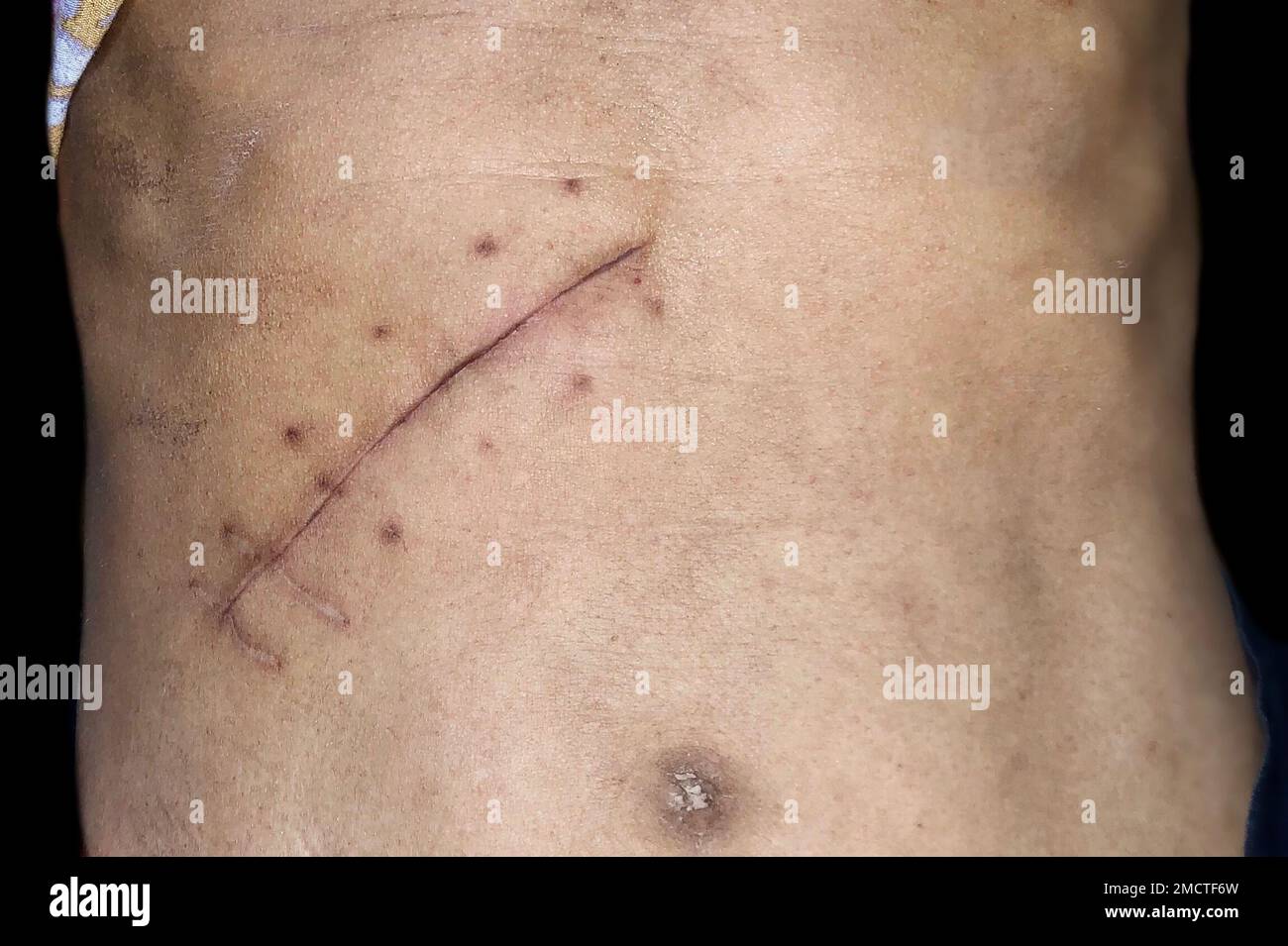 Incisione sottocostale immagini e fotografie stock ad alta risoluzione ...