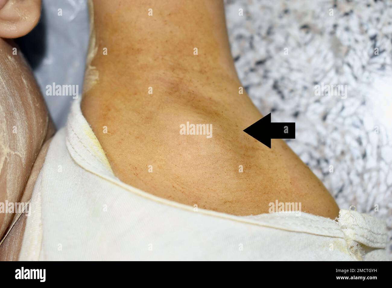 Linfa ascellare gonfia immagini e fotografie stock ad alta risoluzione ...