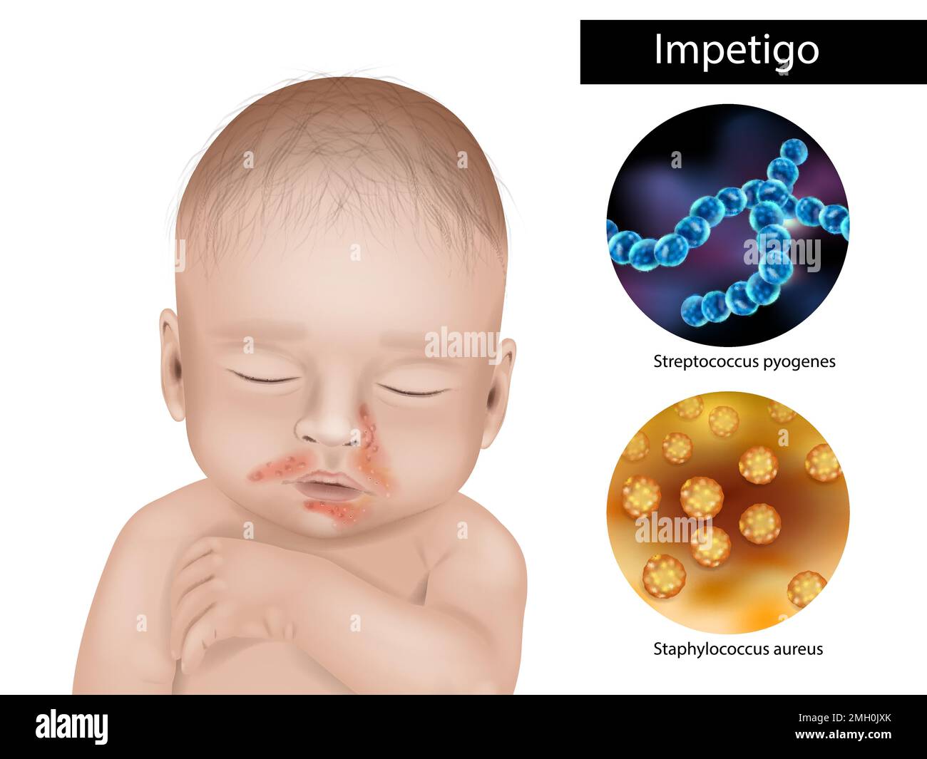 Staphylococcus aureus impetigine Immagini Vettoriali Stock - Alamy