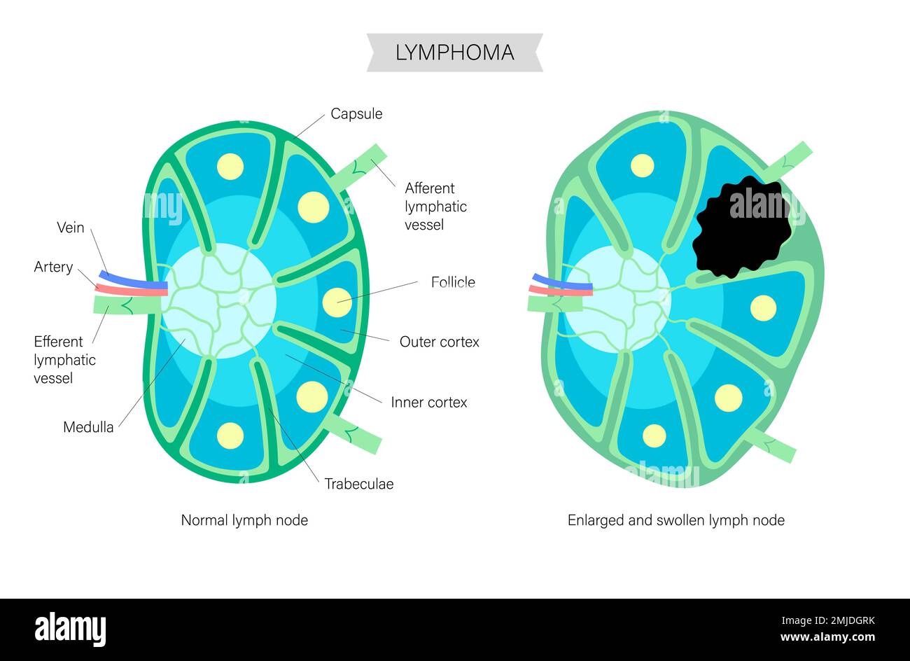 Linfonodi linfoma immagini e fotografie stock ad alta risoluzione - Alamy
