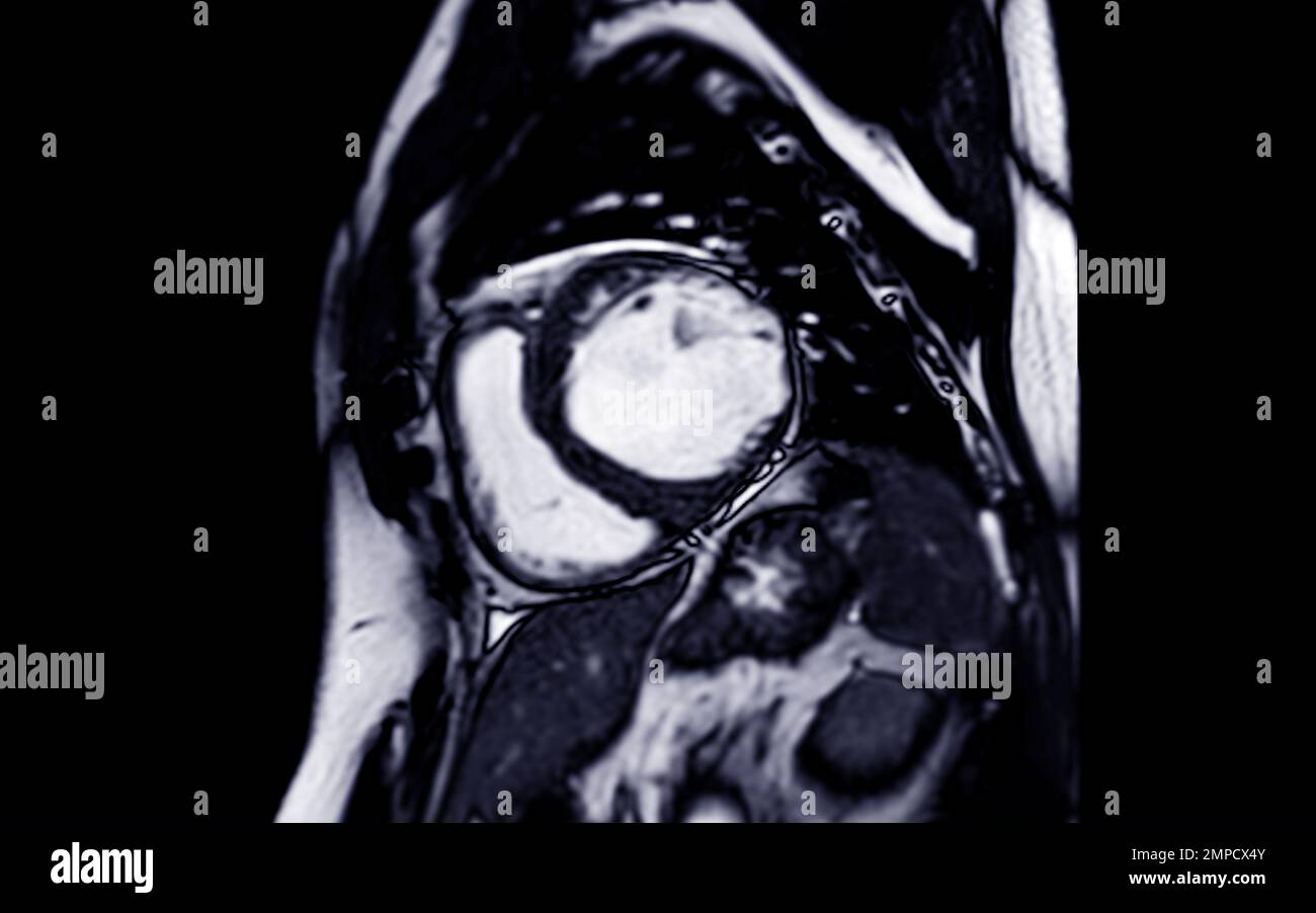MRI Heart o Cardiac MRI (MRI cardiaca) nella vista dell'asse corto che ...