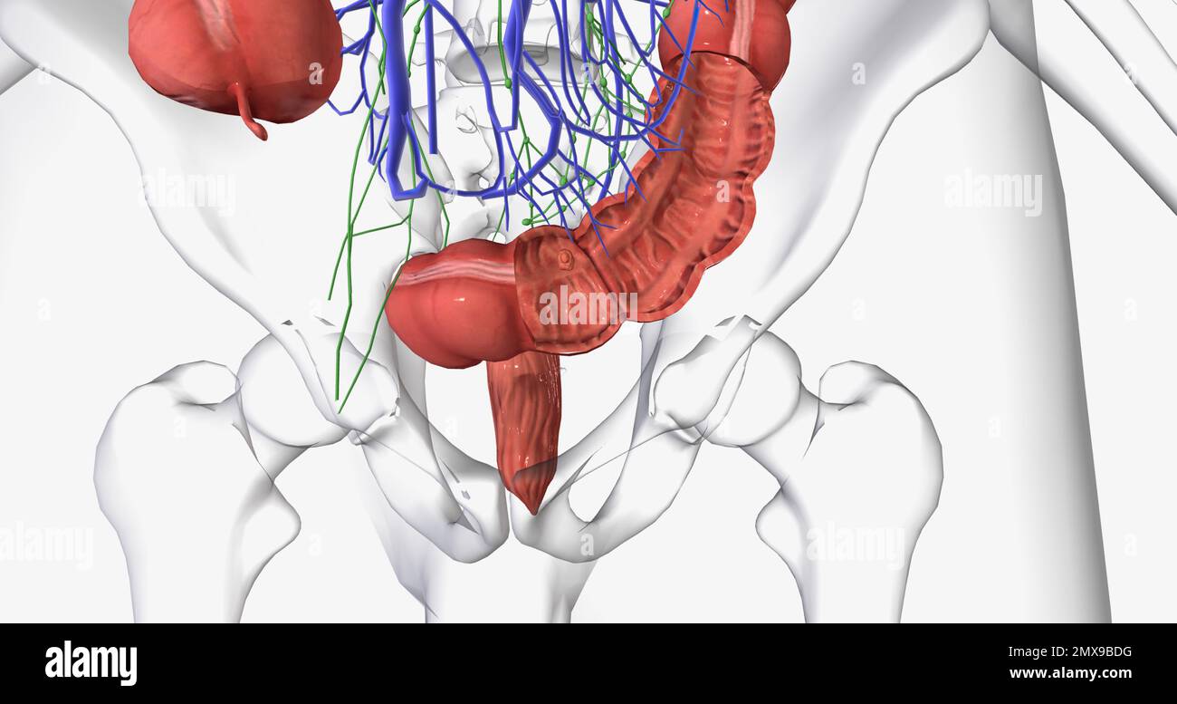 Il cancro del colon-retto (CRC) è un cancro del colon o del retto ... Il cancro del colon-retto (CRC) è un cancro del colon o del retto ...