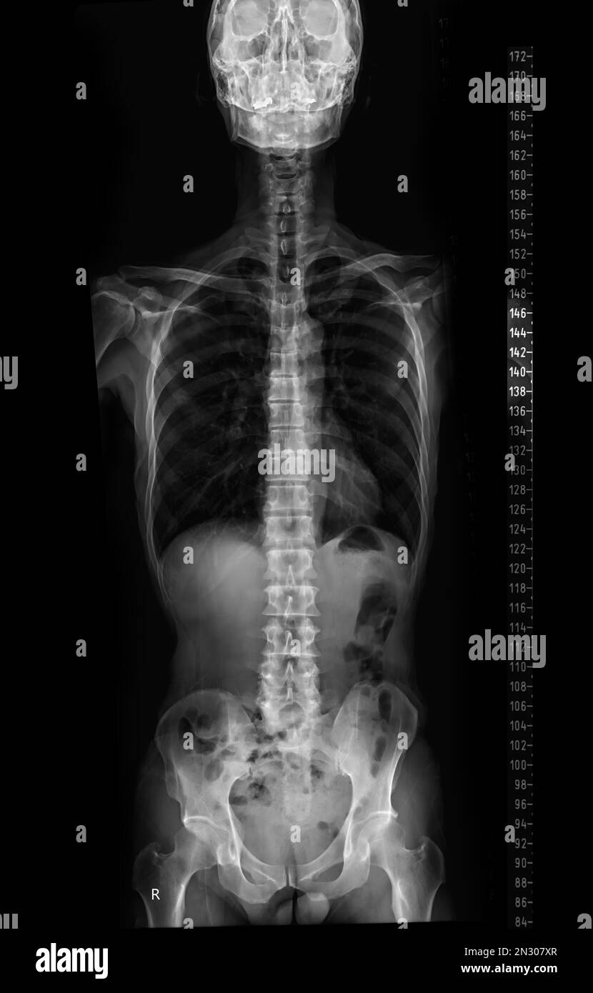 Brutta Radiografia Della Scoliosi