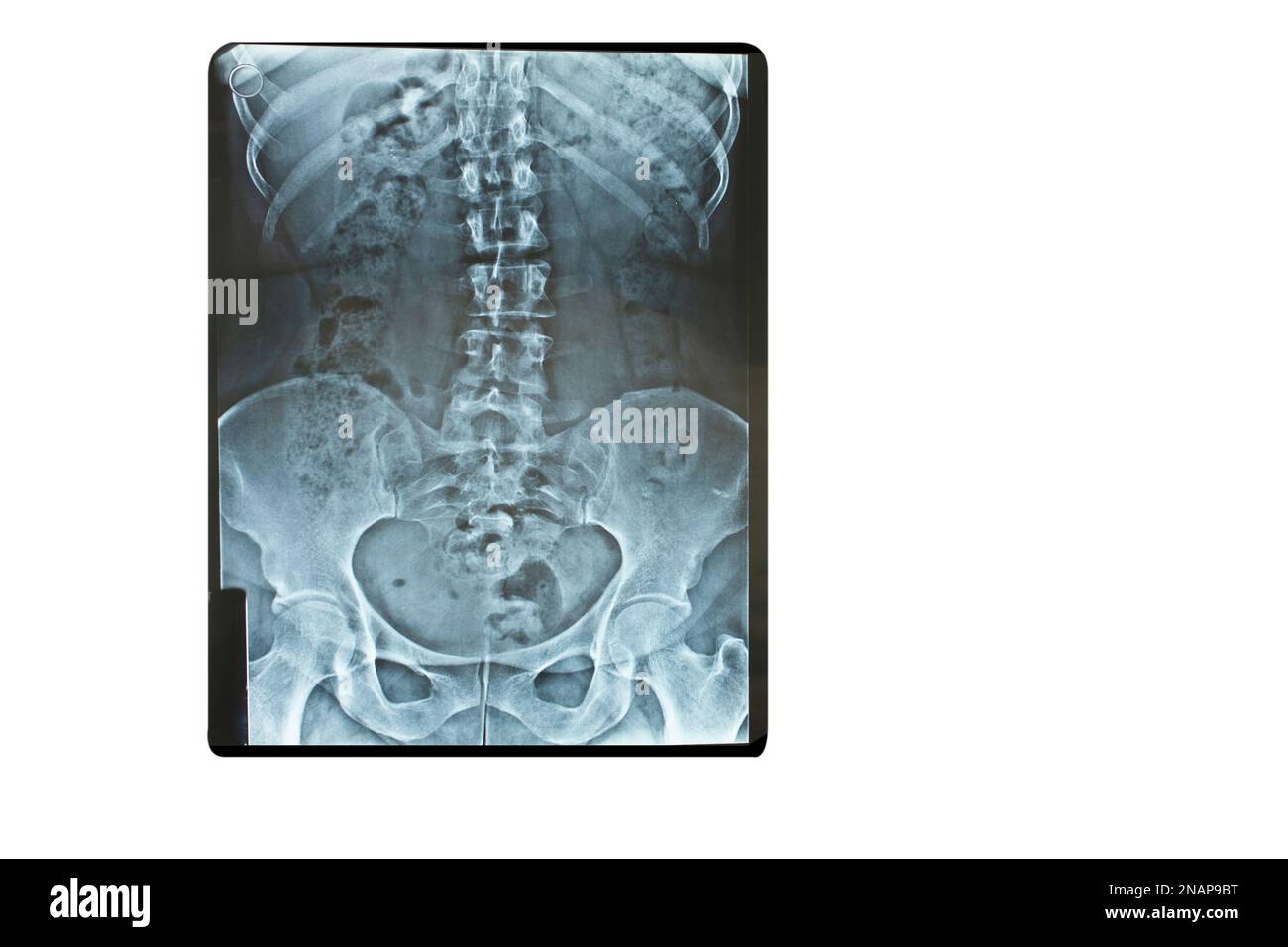 Postura della colonna vertebrale umana quando la scoliosi congenita è ...