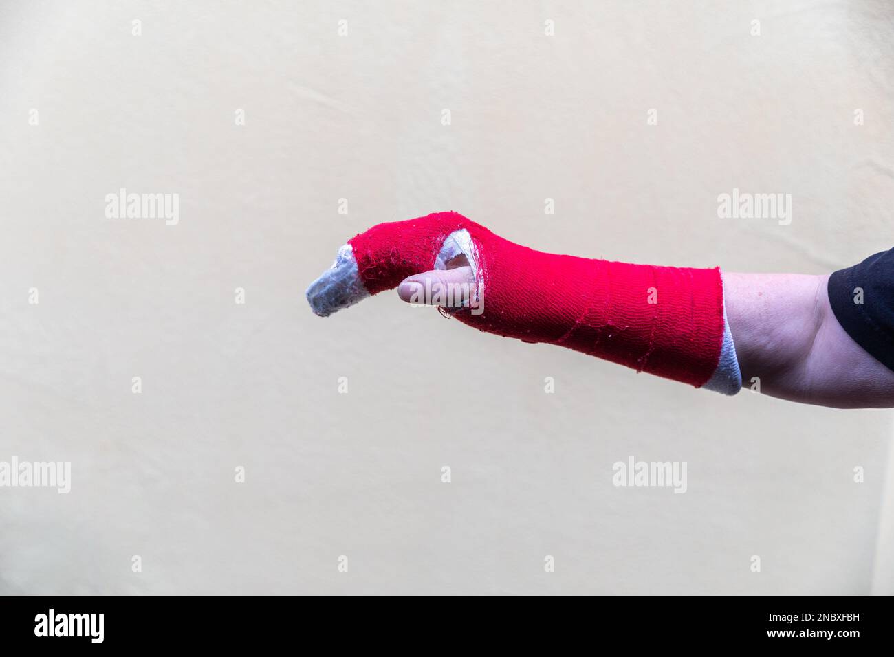 Osso del braccio rotto immagini e fotografie stock ad alta risoluzione ...