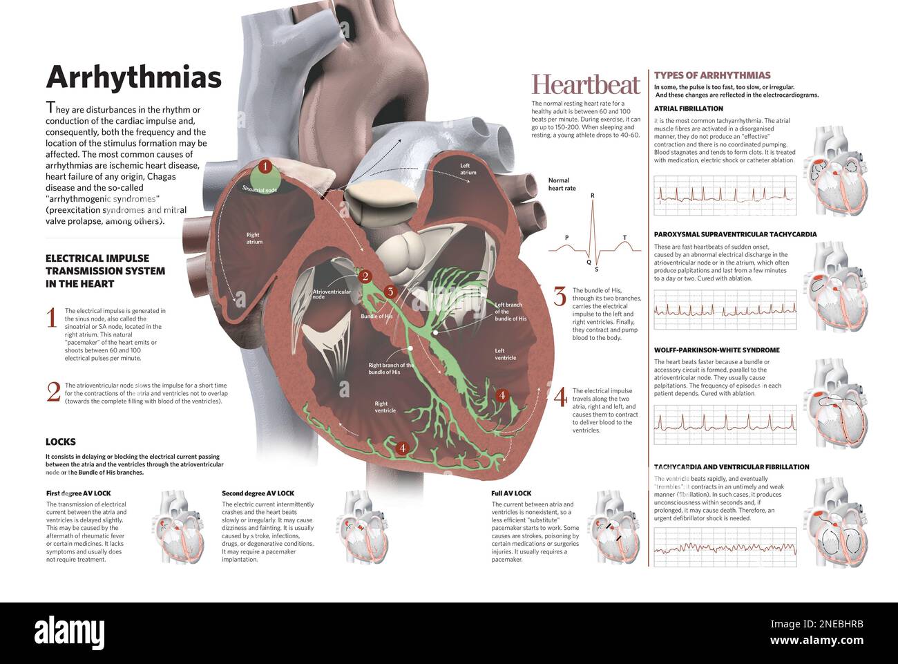 Infografica sulle aritmie, alterazioni del battito cardiaco. Vi è anche ...