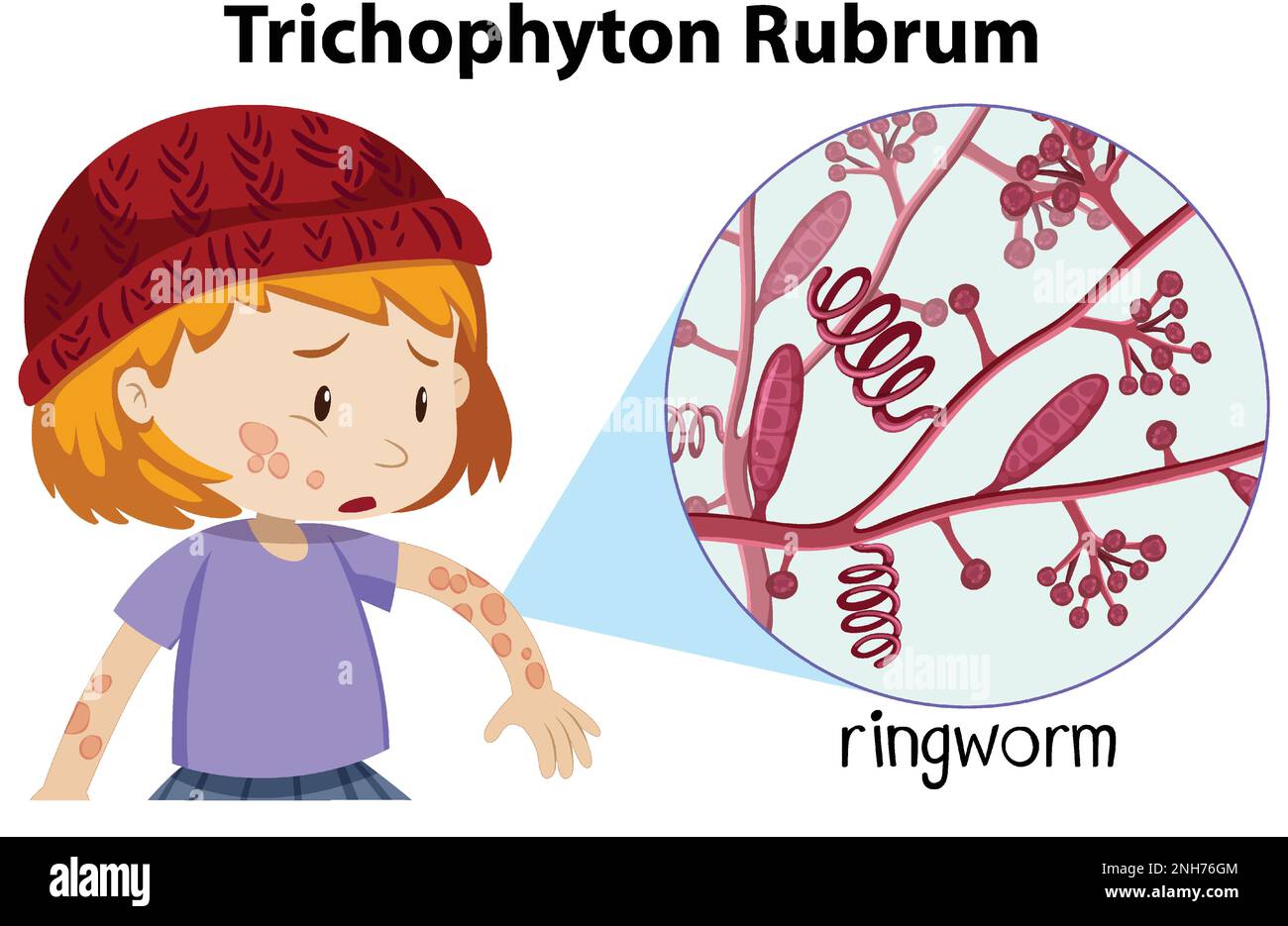 Trichophyton rubrum immagini e fotografie stock ad alta risoluzione - Alamy