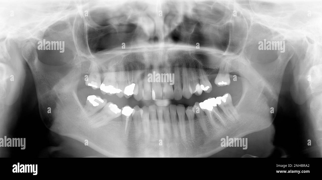 Radiografia medica Foto e Immagini Stock in Bianco e Nero - Alamy