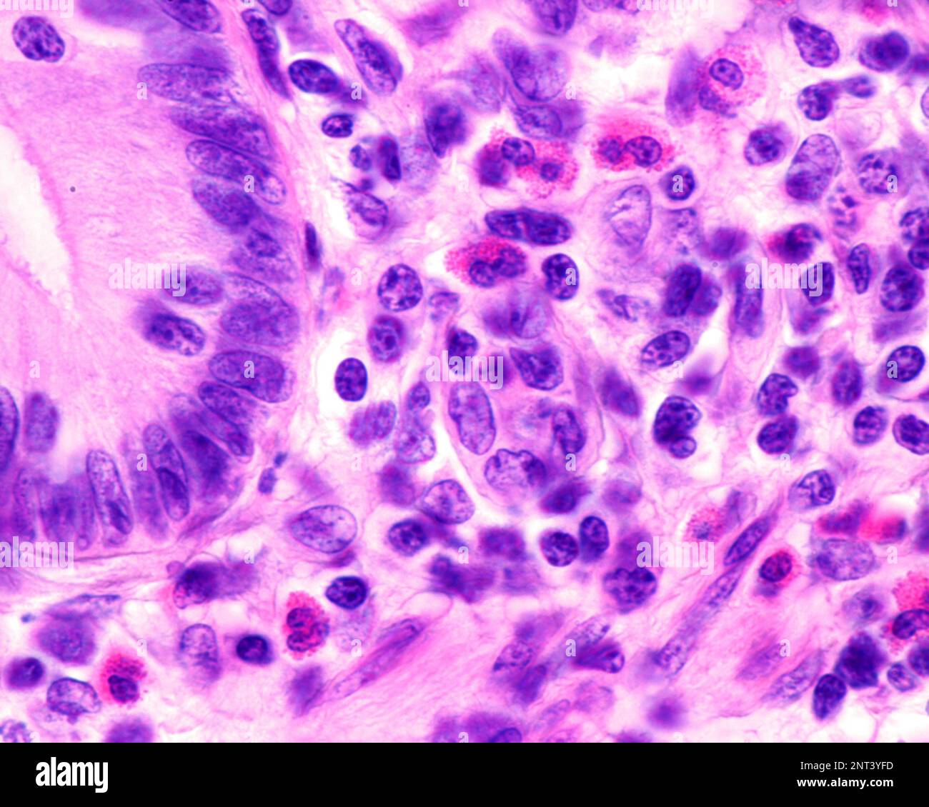 Micrografia al microscopio ottico che mostra granulociti eosinofili ...