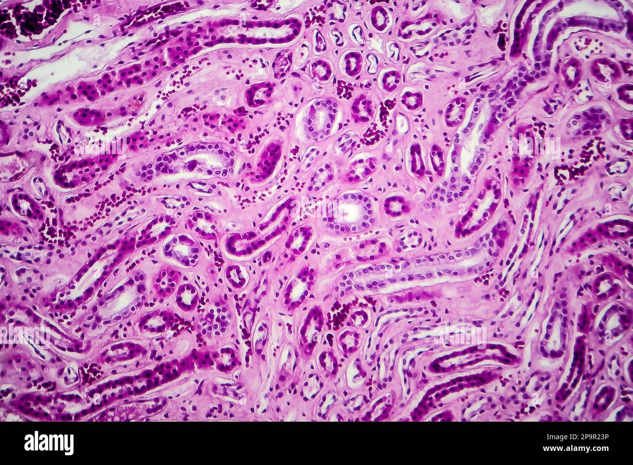 Célula de lupus eritematoso immagini e fotografie stock ad alta ...