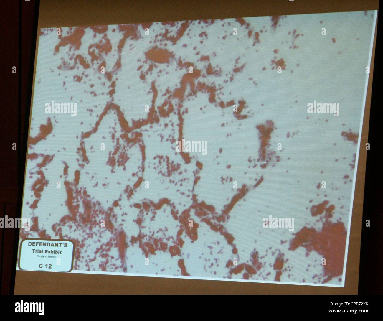 A photograph showing air sacs from the lung of Lana Clarkson, taken by ...