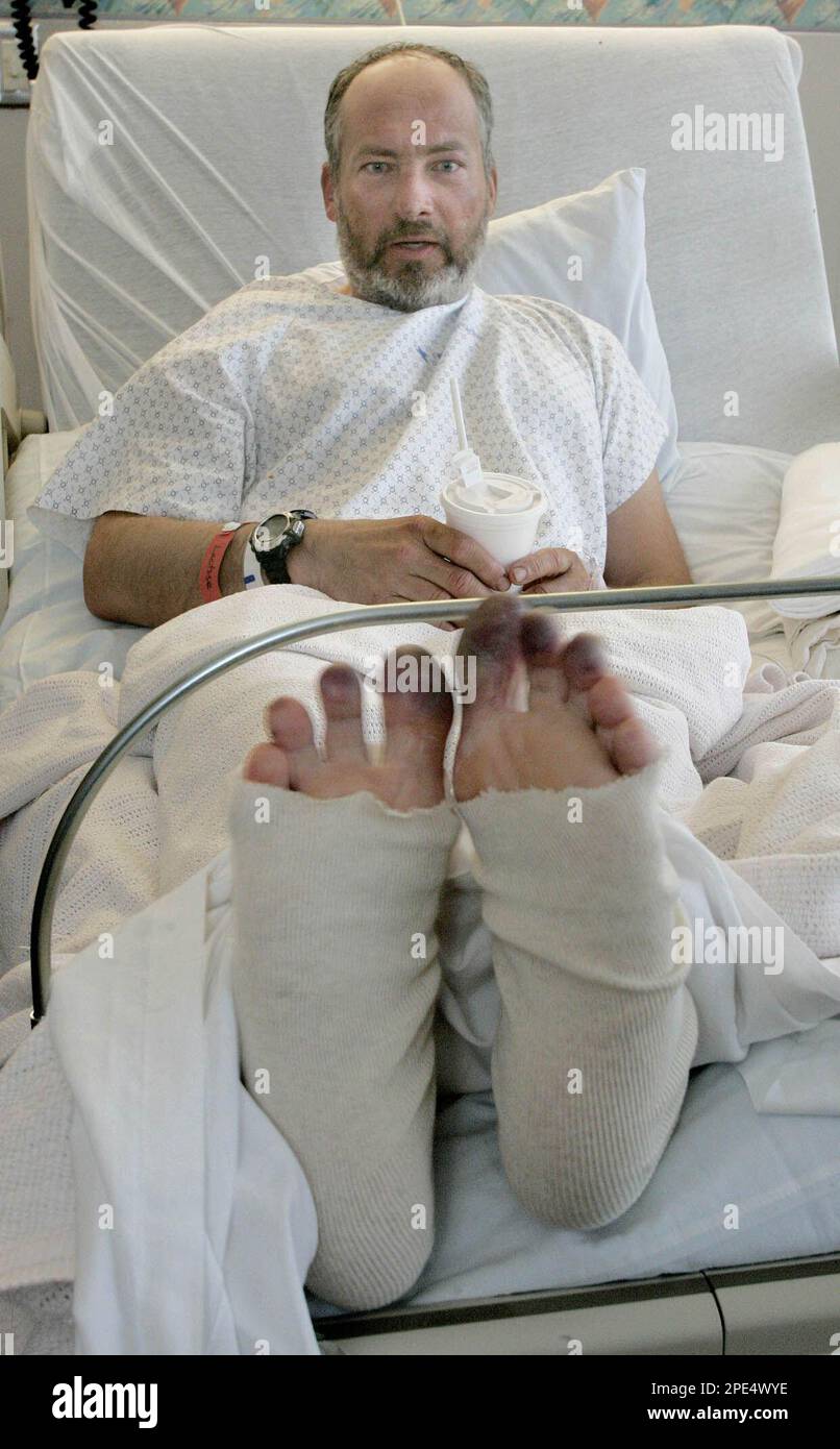 Alex Snigurowicz shows the frostbite on his toes Saturday, May 28, 2005 ...