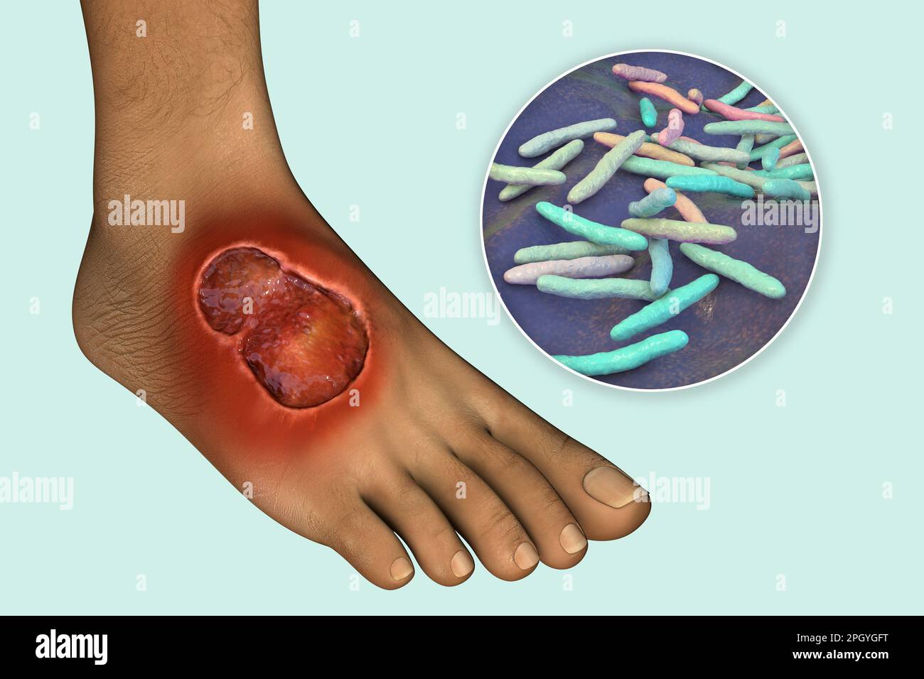 Mycobacterium ulcerans immagini e fotografie stock ad alta risoluzione ...