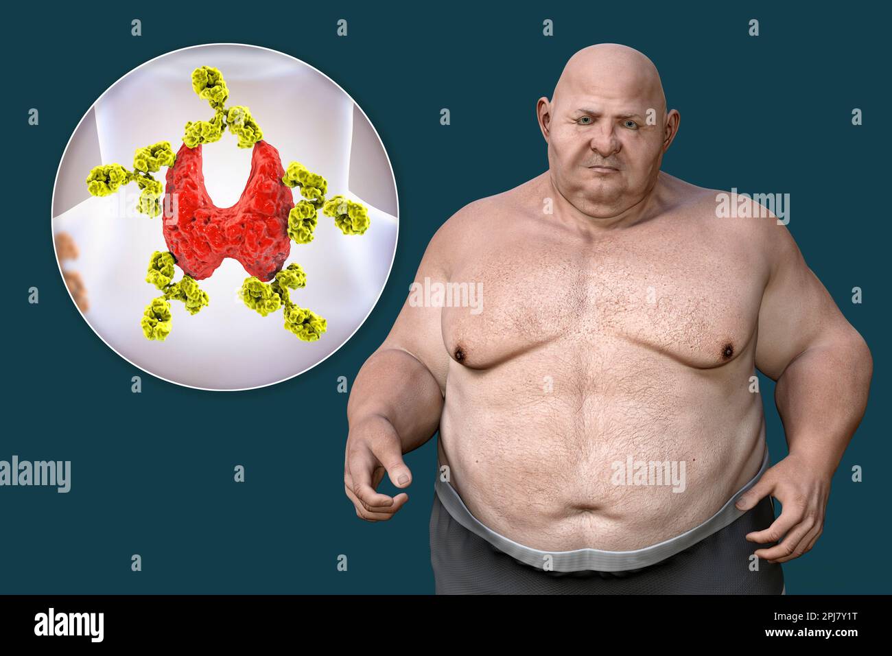 Malattia tiroidea autoimmune immagini e fotografie stock ad alta ...