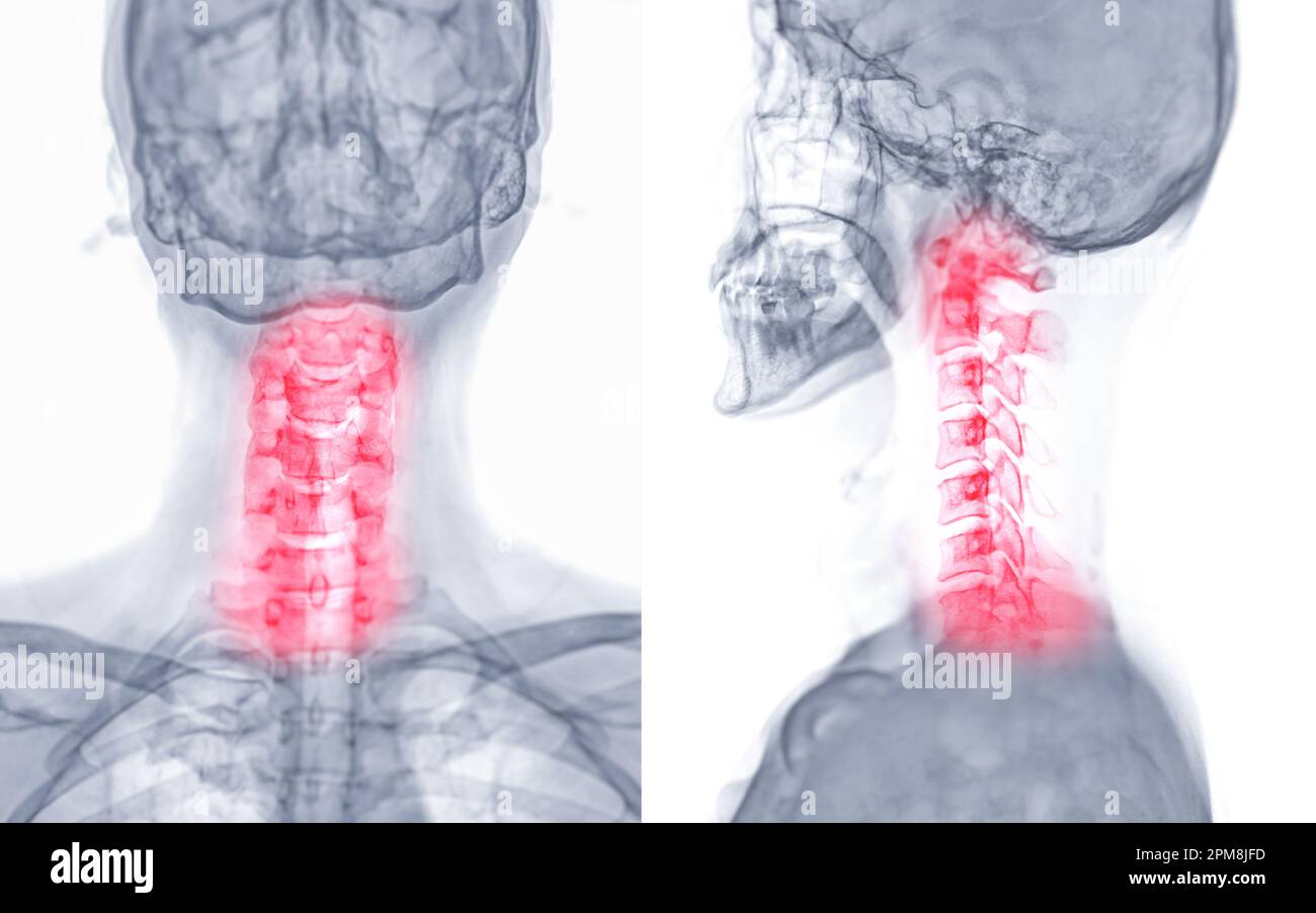 Immagine radiografica della colonna vertebrale C o radiografica della ...