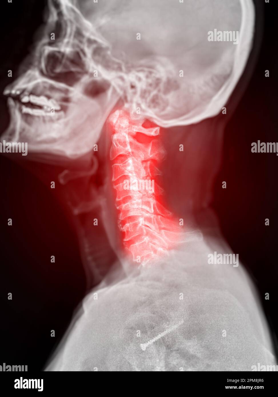 Immagine radiografica della colonna vertebrale cervicale o radiologica ...