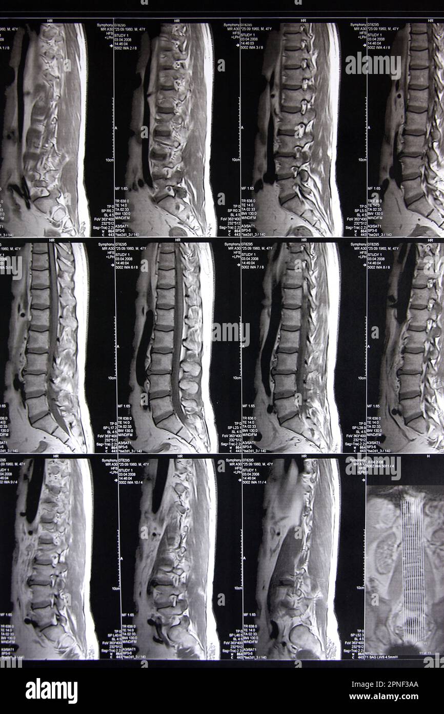 Imaging della colonna vertebrale immagini e fotografie stock ad alta ...