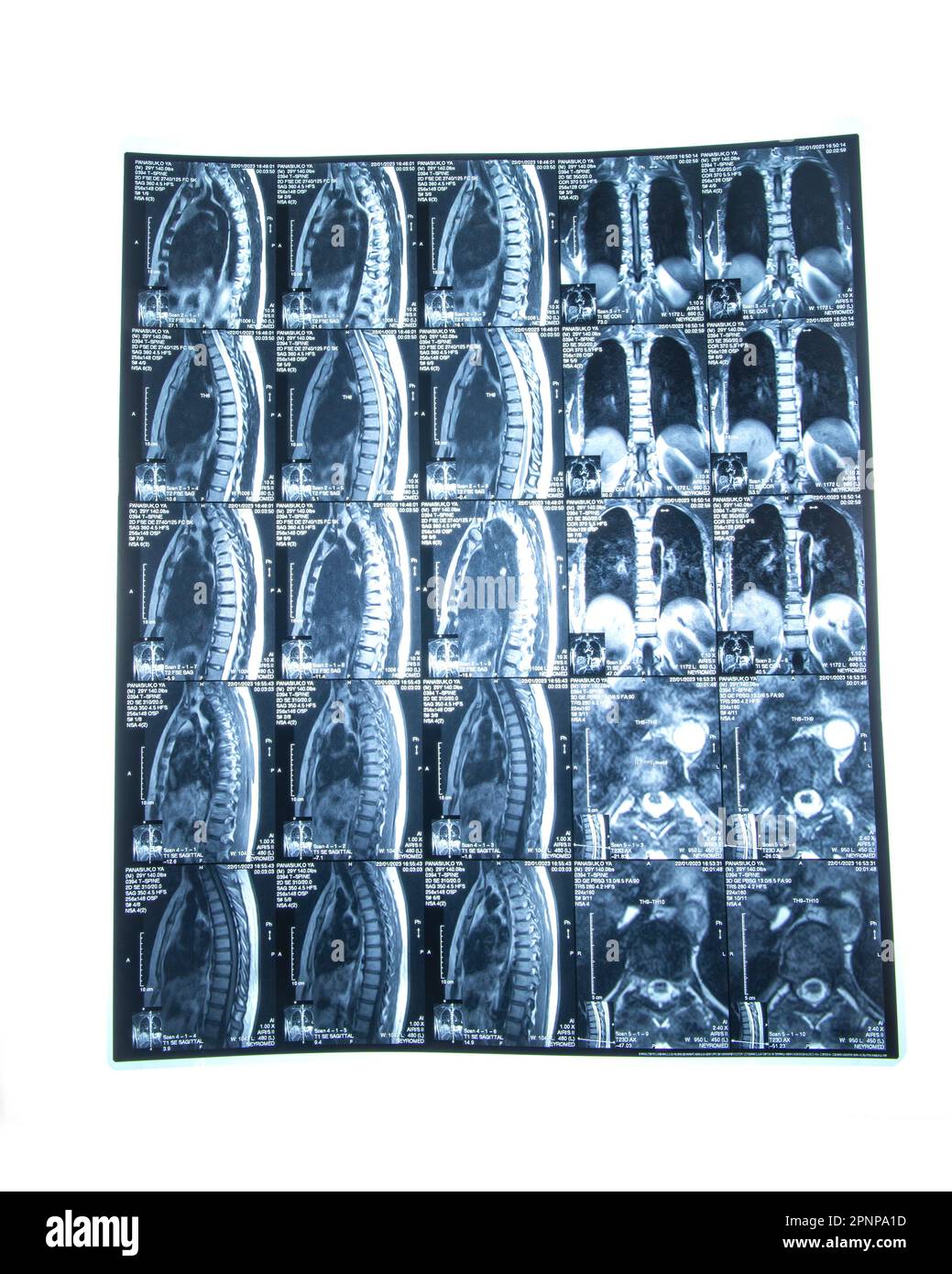 Mri di colonna lombare Immagini senza sfondo e Foto Stock ritagliate ...