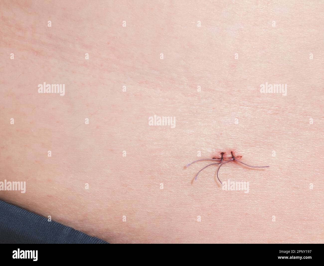 Wound care abdomen immagini e fotografie stock ad alta risoluzione - Alamy
