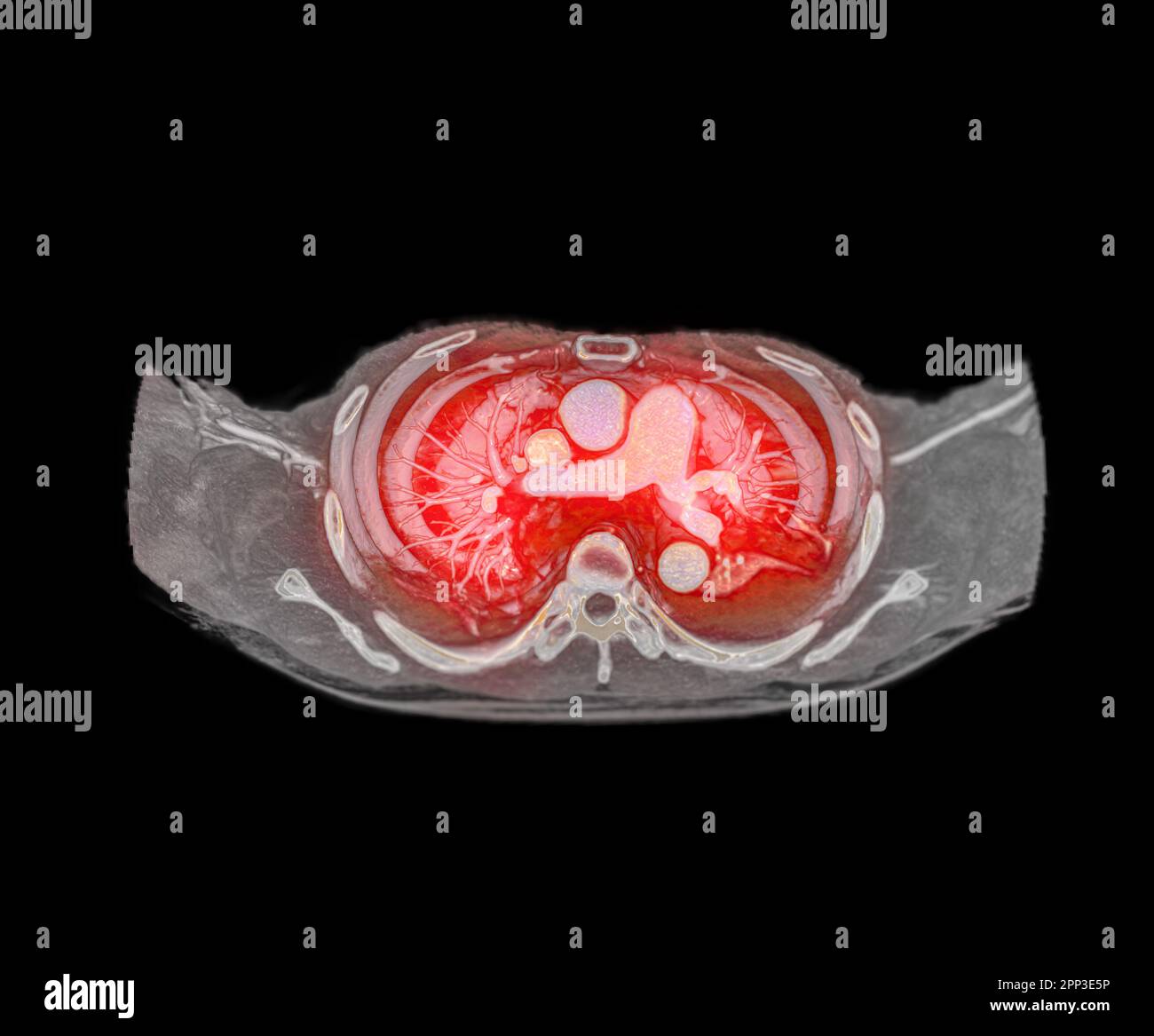 Arteria polmonare cta immagini e fotografie stock ad alta risoluzione ...