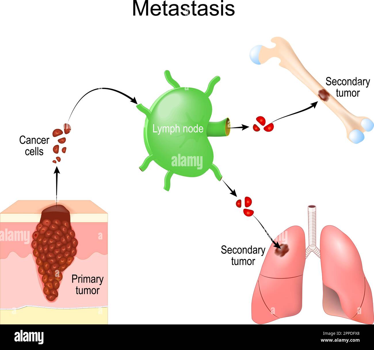 Metastasi. Le cellule tumorali del tumore primario sopravvivono nel linfonodo e si diffondono ad ...