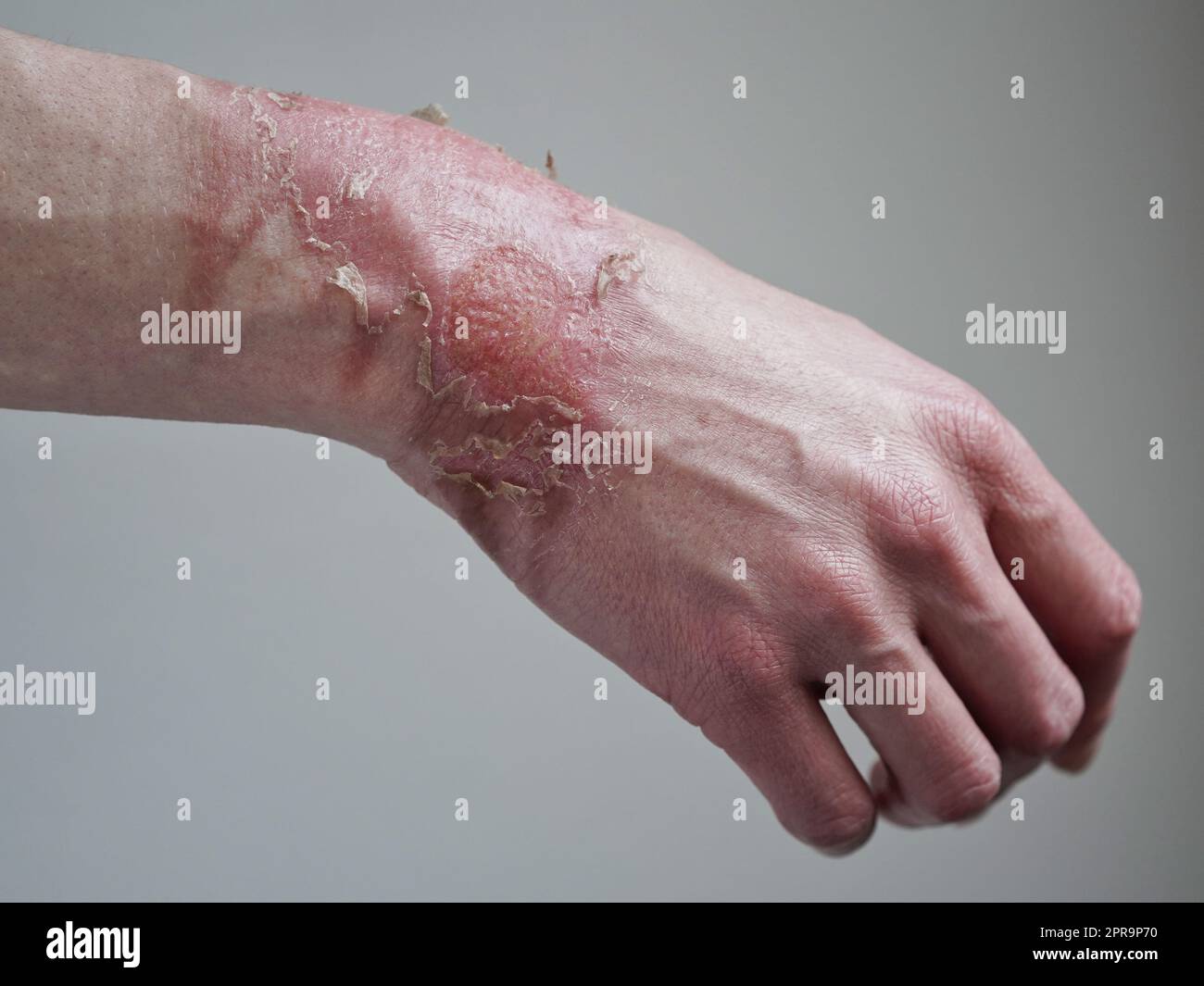 Burn injury 2 grado immagini e fotografie stock ad alta risoluzione - Alamy