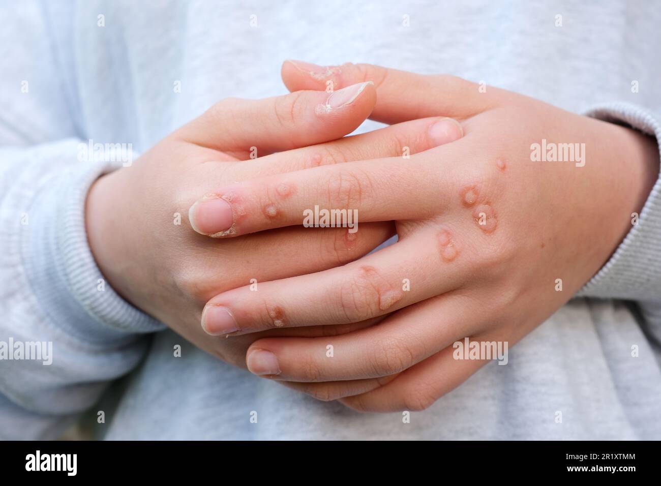 Verruca a mano immagini e fotografie stock ad alta risoluzione - Alamy
