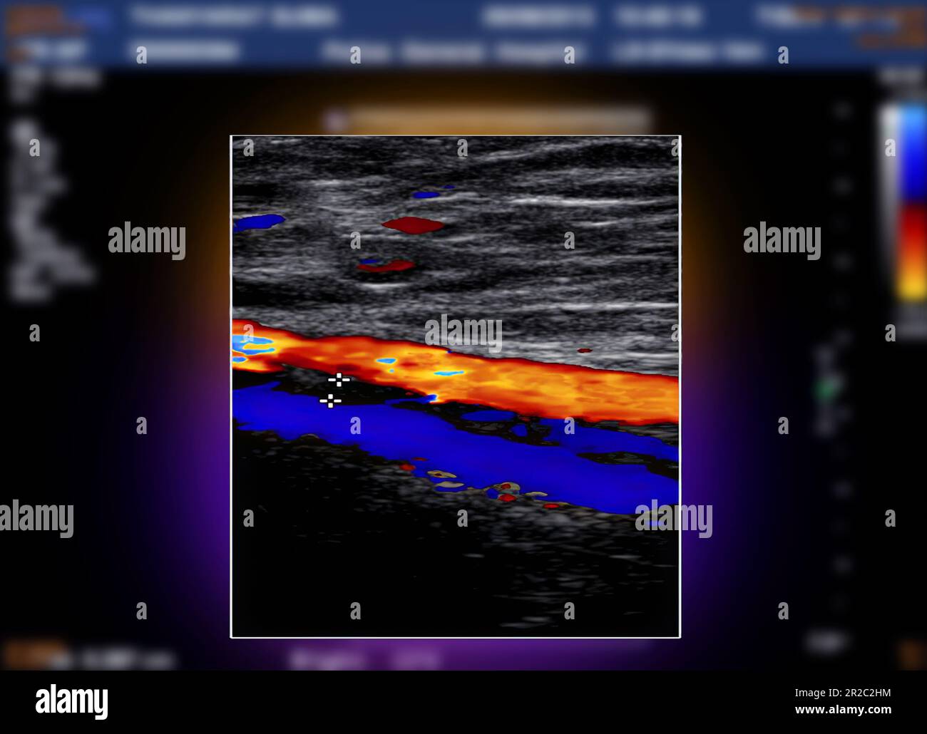 Ecografia carotidea doppler immagini e fotografie stock ad alta ...