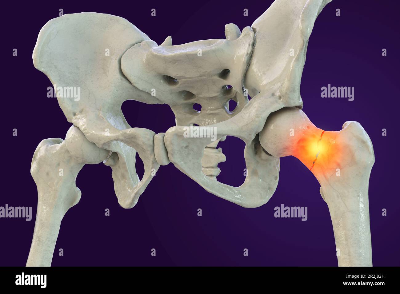 Bone fracture immagini e fotografie stock ad alta risoluzione - Alamy