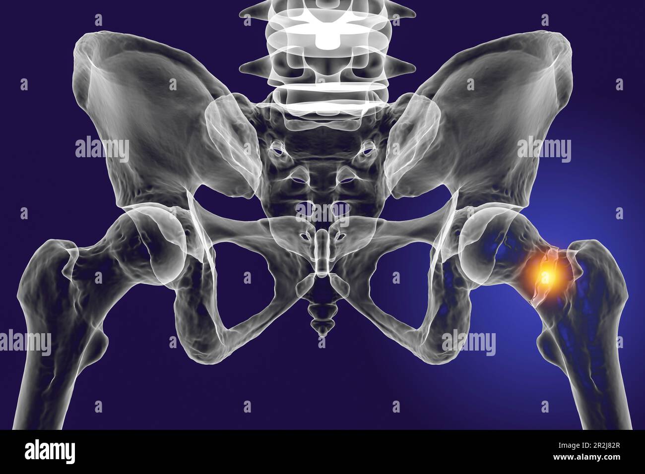 Bone fracture immagini e fotografie stock ad alta risoluzione - Alamy