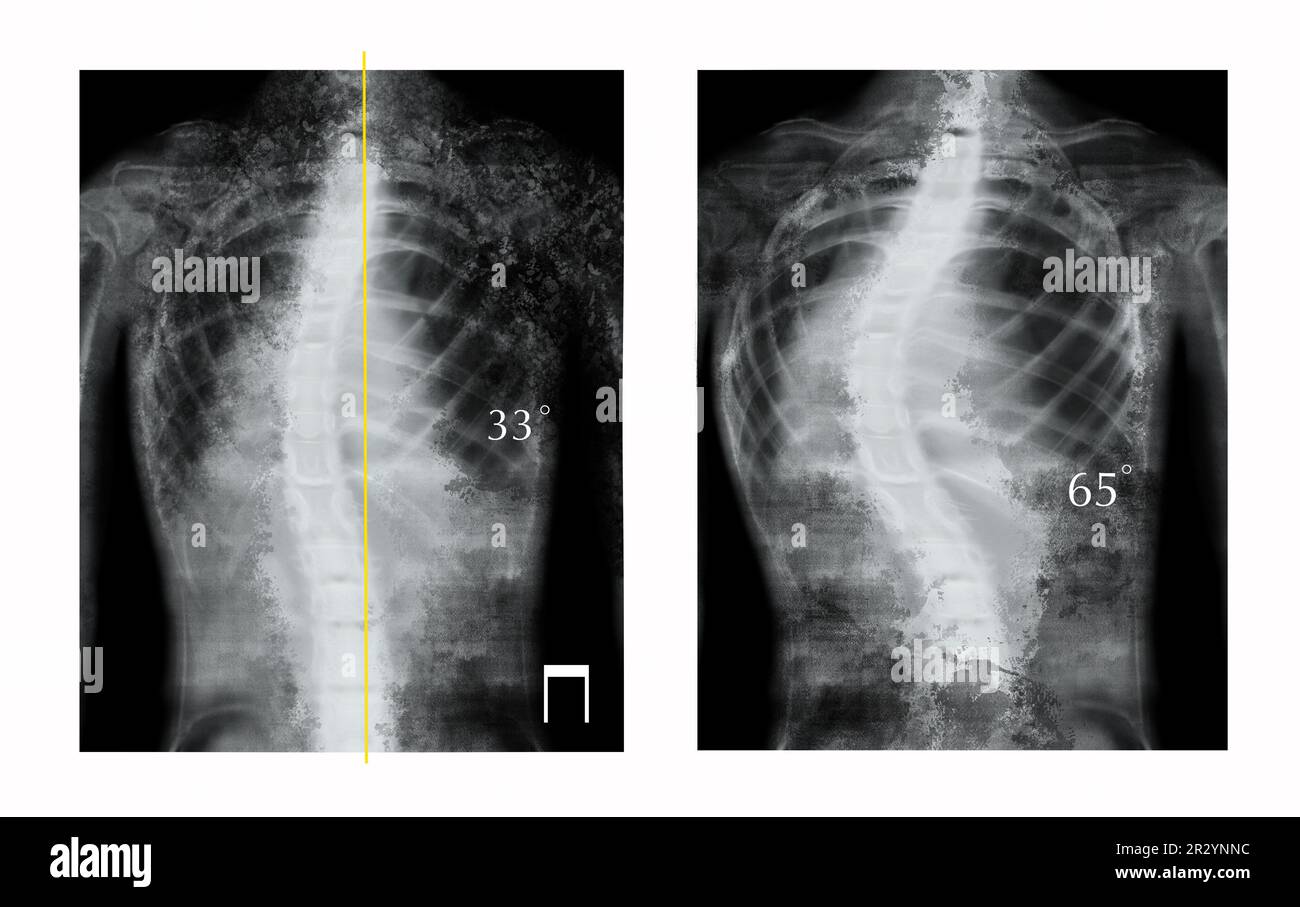 Scoliosi congenita immagini e fotografie stock ad alta risoluzione - Alamy